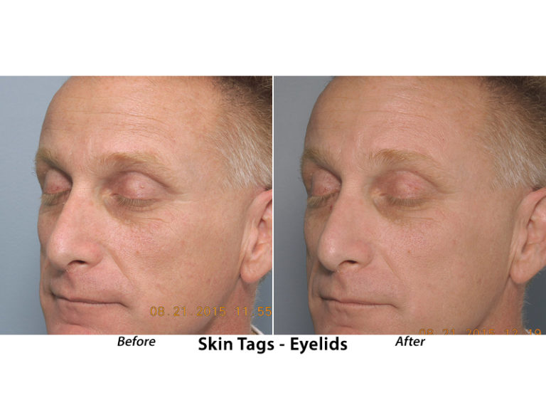 Skin Tag Removal Dermatologist - Reston Dermatology + Cosmetic Center