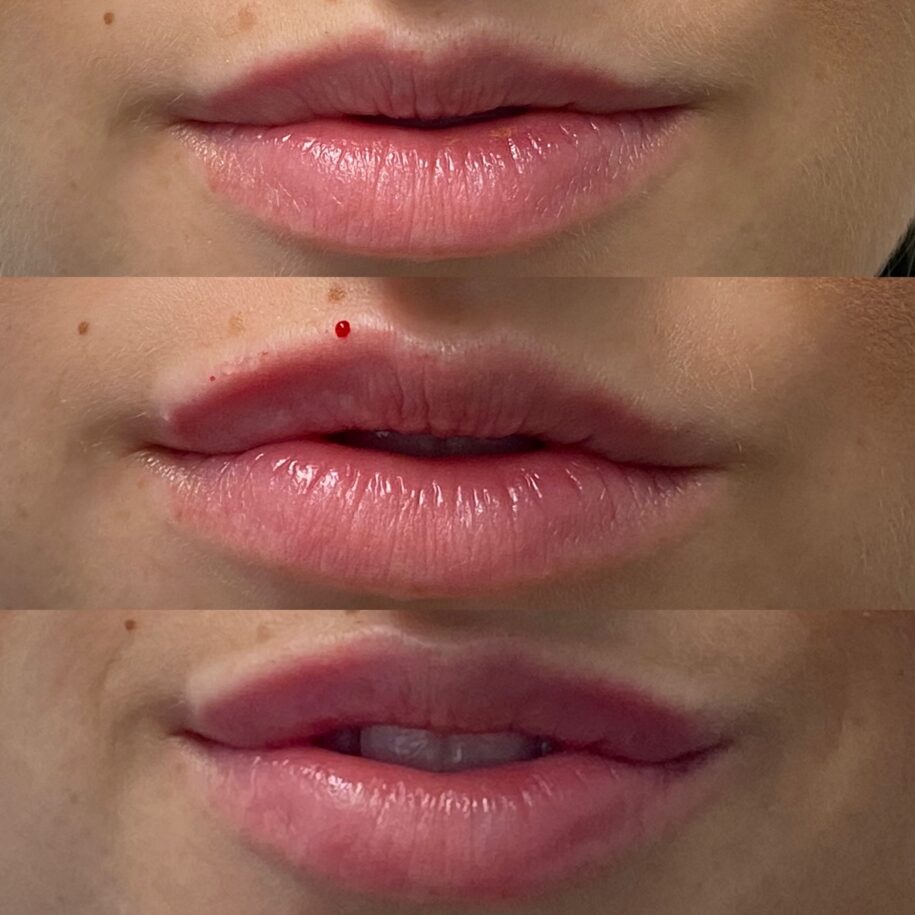 Lip Injections - Reston Dermatology + Cosmetic Center