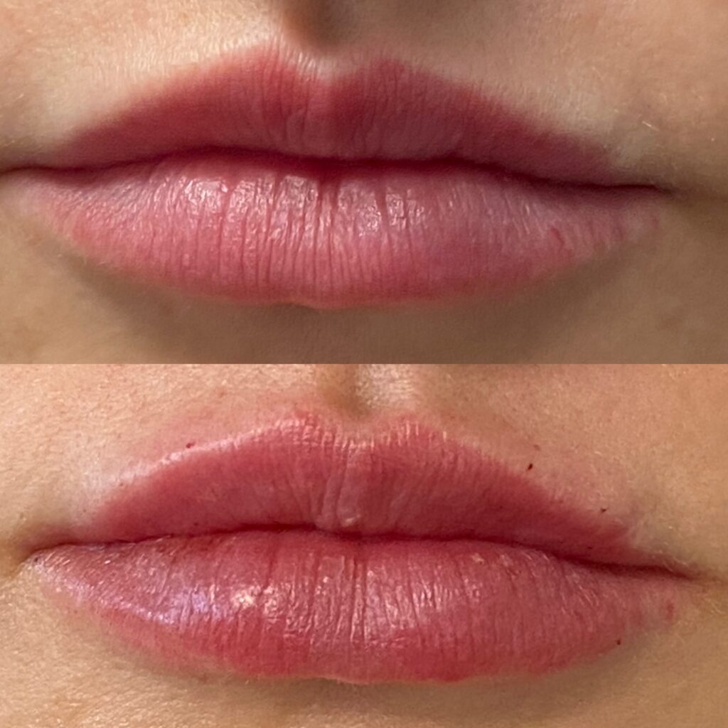 Lip Injections - Reston Dermatology + Cosmetic Center