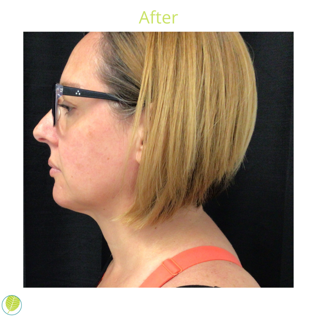 Under Chin Fullness Double Chin Treatments Northern Virginia - Reston ...