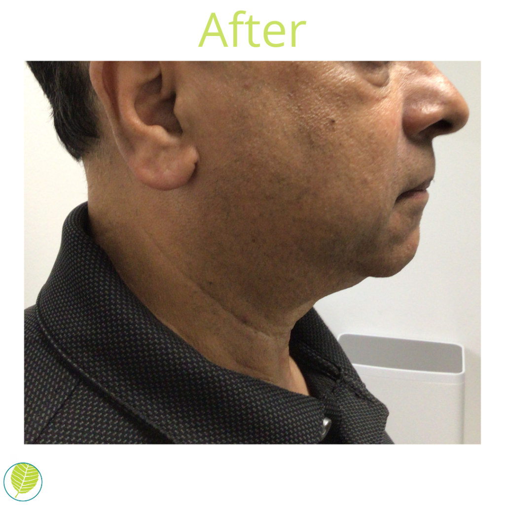 Under Chin Fullness Double Chin Treatments Northern Virginia - Reston ...