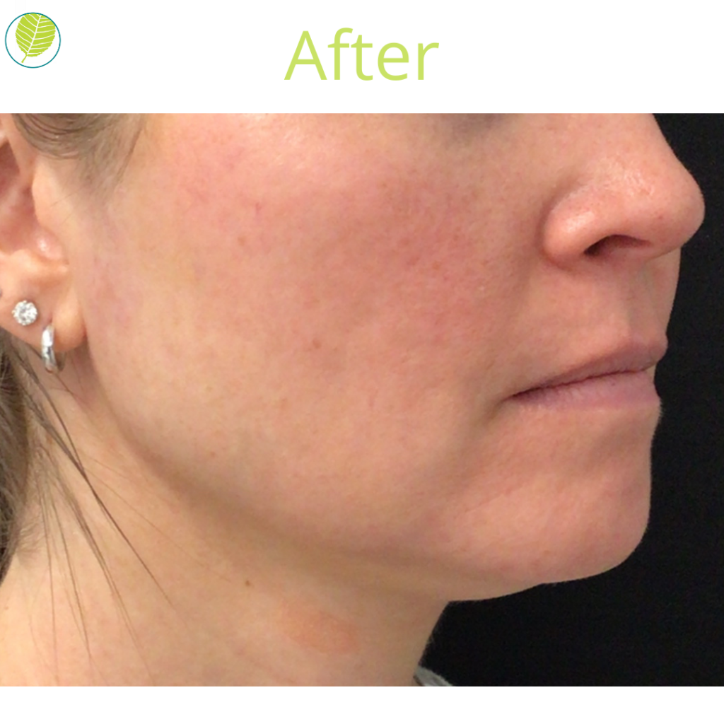 Under Chin Fullness Double Chin Treatments Northern Virginia - Reston ...