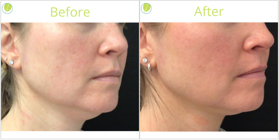 Under Chin Fullness Double Chin Treatments Northern Virginia - Reston ...