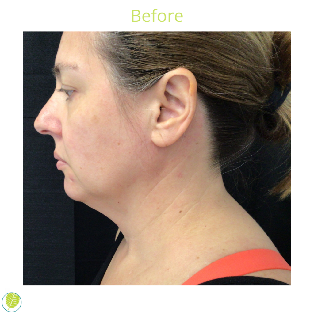 Under Chin Fullness Double Chin Treatments Northern Virginia - Reston ...