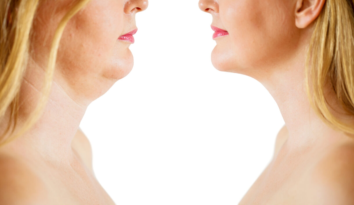 Under Chin Fullness Double Chin Treatments Northern Virginia - Reston ...