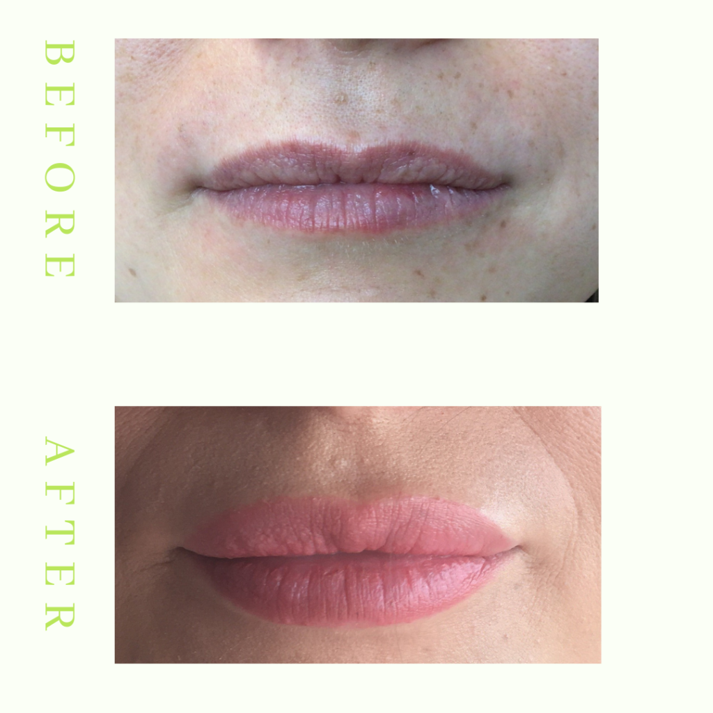 Lip Injections - Reston Dermatology + Cosmetic Center