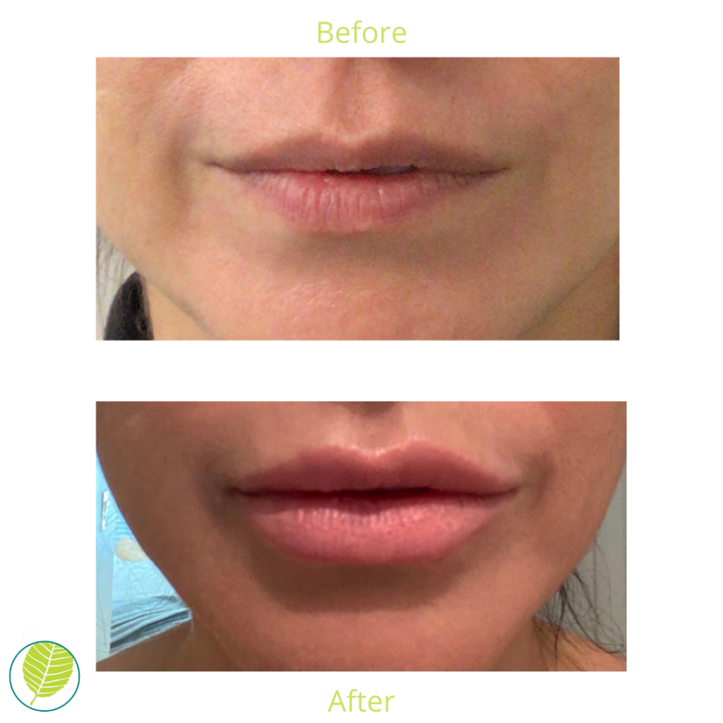 Lip Injections - Reston Dermatology + Cosmetic Center