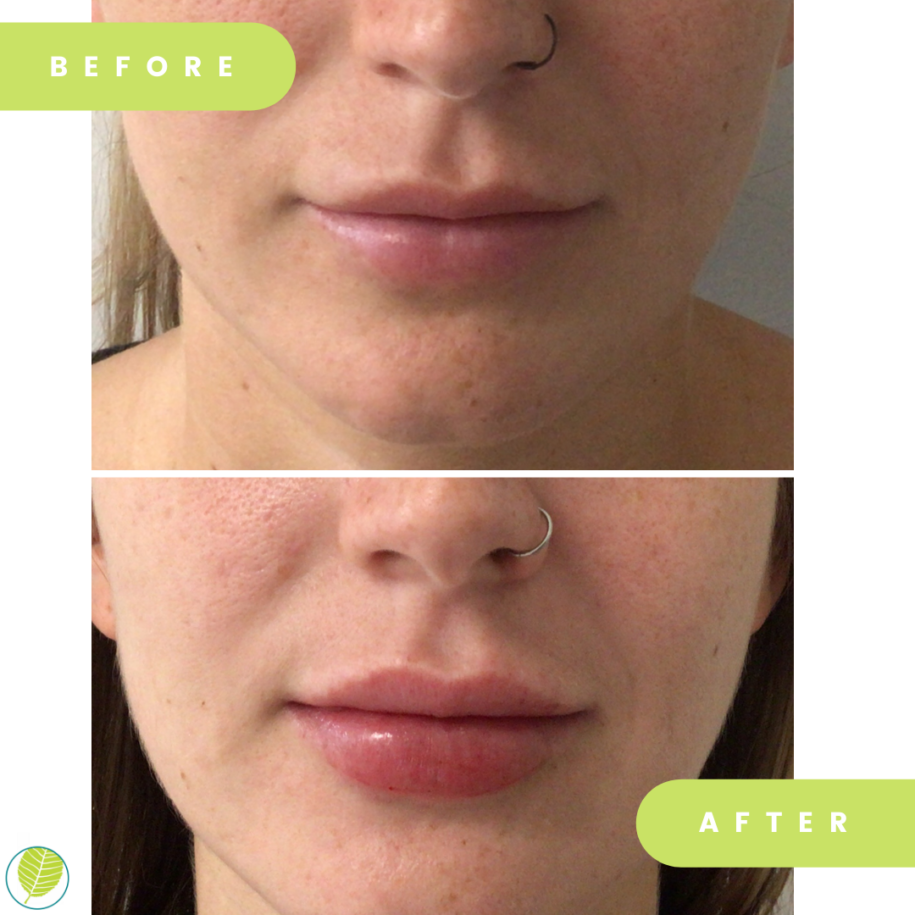 Lip Injections - Reston Dermatology + Cosmetic Center
