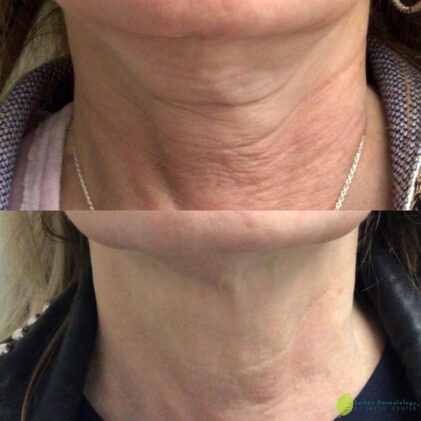 The Best Treatment for Neck Sagging - Reston Dermatology + Cosmetic Center