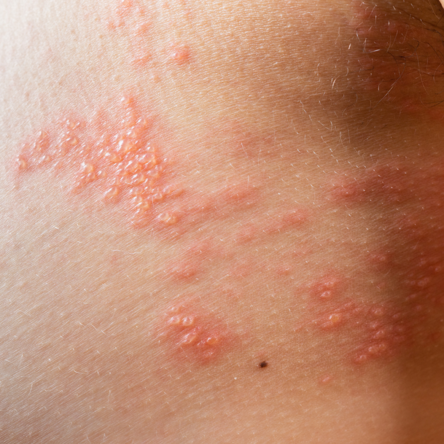 Same Day Dermatology Appointment Northern Virginia - Reston Dermatology ...