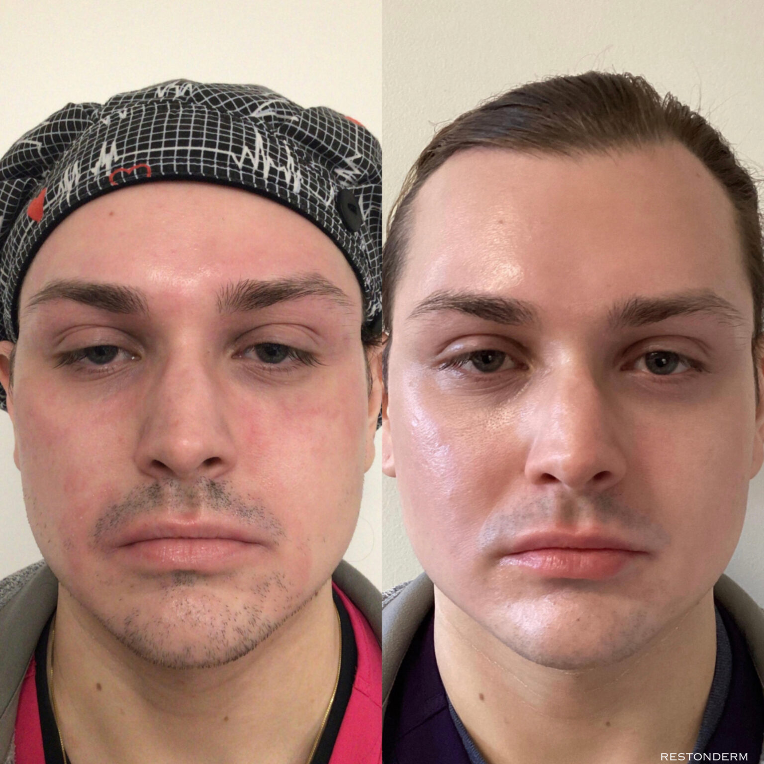 Facial Contouring - Reston Dermatology + Cosmetic Center